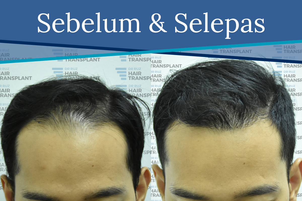Pusat Tanam Rambut Malaysia – Hair Transplant Malaysia