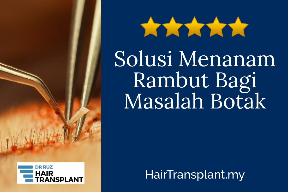 Solusi Tanam Rambut untuk Merawat Masalah Botak – Hair Transplant Malaysia